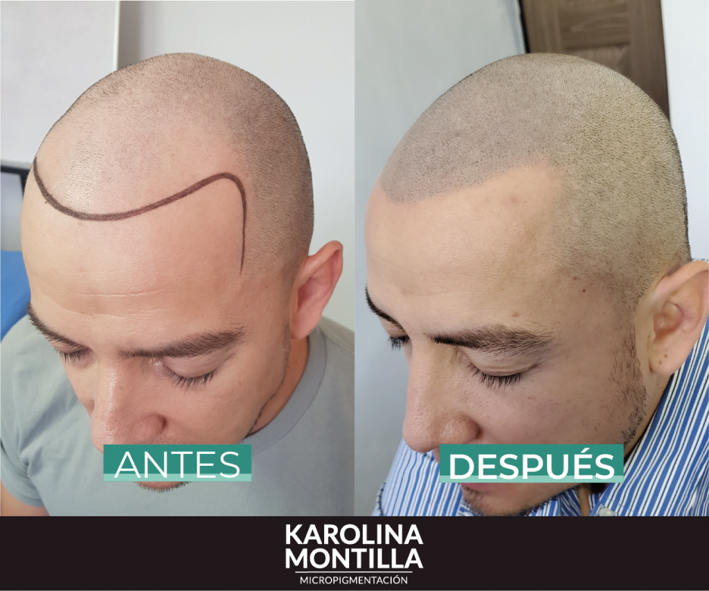 Micropigmentación Capilar - Karolina Montilla