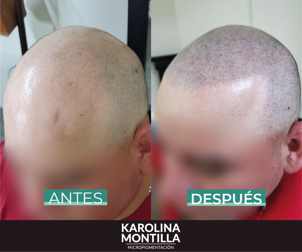 Micropigmentación Capilar - Karolina Montilla
